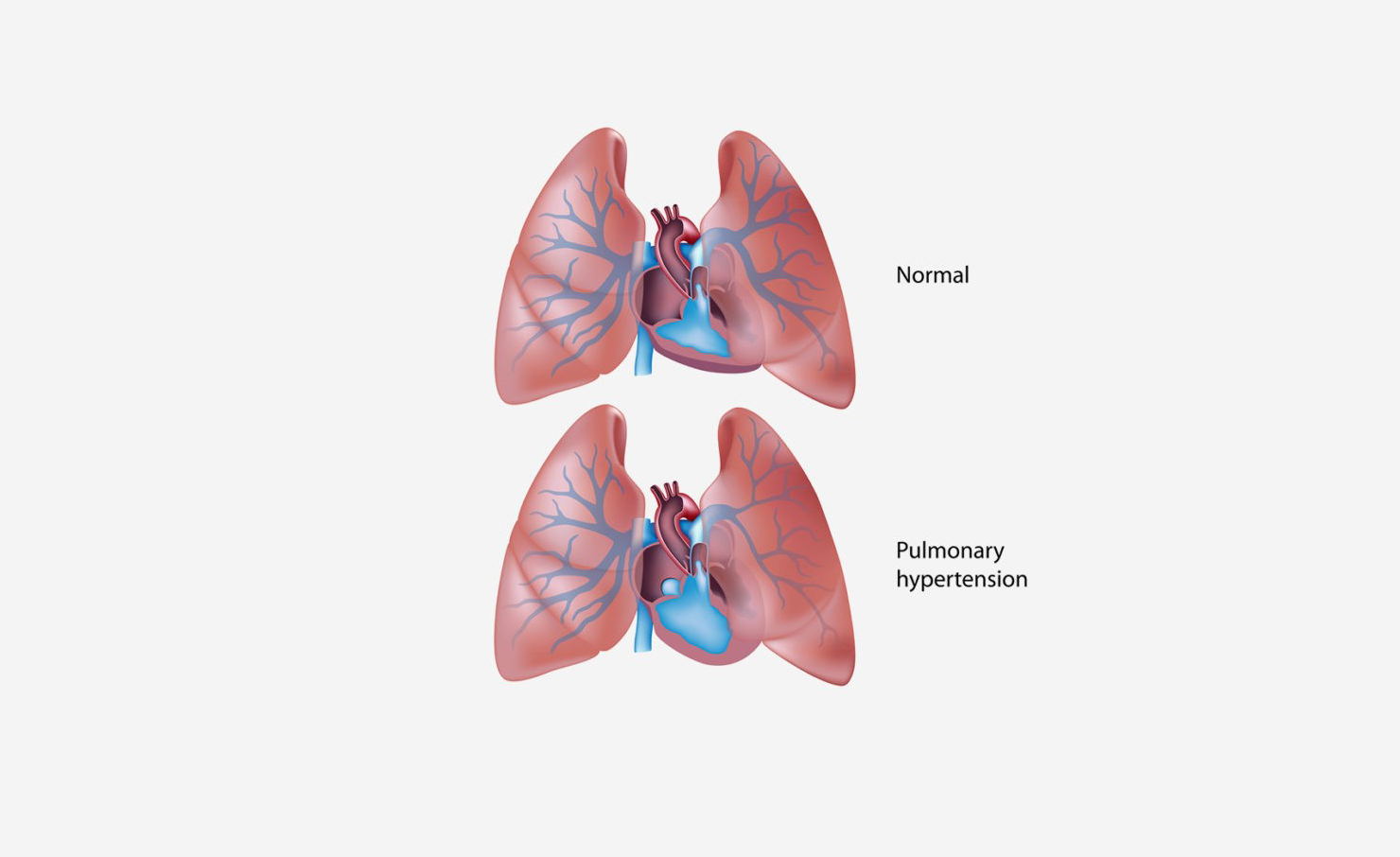 Wat is PH? - Erasmus PAH